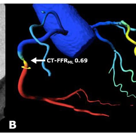 66 Year Old Female Patient With Suspected Progress Of CAD And A High Download Scientific