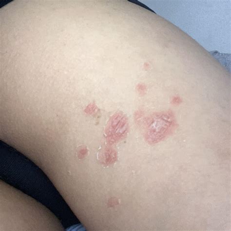 Fungal Infection Top Of Thigh