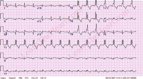 Right Bundle Branch Block Example 2
