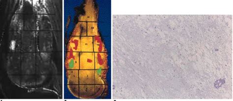Osteosarcoma Correlation Of T1 Map And Histology Map