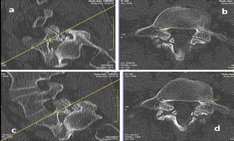 Grade 4 Listhesis Showing Pedicle Height Measuring 2 9 Mm On R A And Download Scientific
