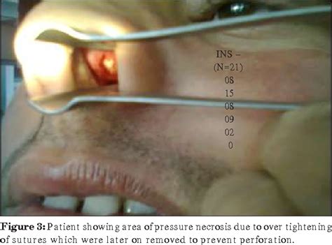 Deviated Septum Surgery Splints