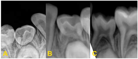 Infraocclusion In The Primary And Permanent Dentition Encyclopedia Mdpi