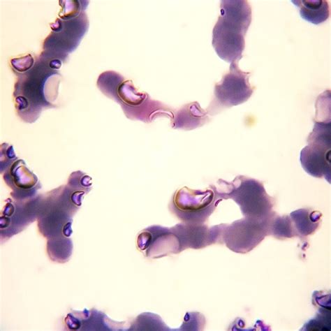 Follicular Cancer Cytoadhesive Erythrocytes With Polymorphic Nuclei