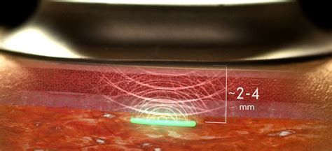 Implantable Sensor For Early Detection Of Infections Medical