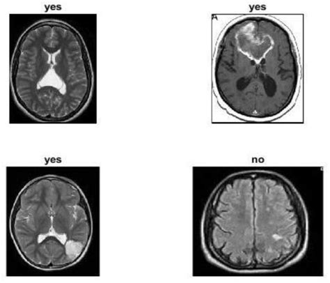 A Hybrid Deep Learning Model For Brain Tumour Classification Pmc