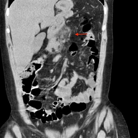Vertical Cross Section Ct Imaging Of The Abdomen With The Arrow Download Scientific Diagram