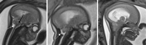 Differences Between Myeloschisis And Myelomeningocele In Patients
