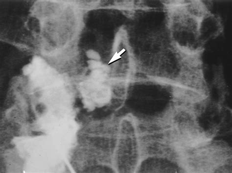 Lumbar Facet Joint Arthrography With The Posterior Approachradiographics