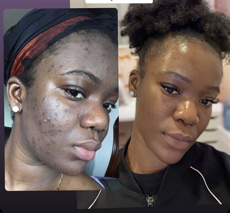 Chemical Peels