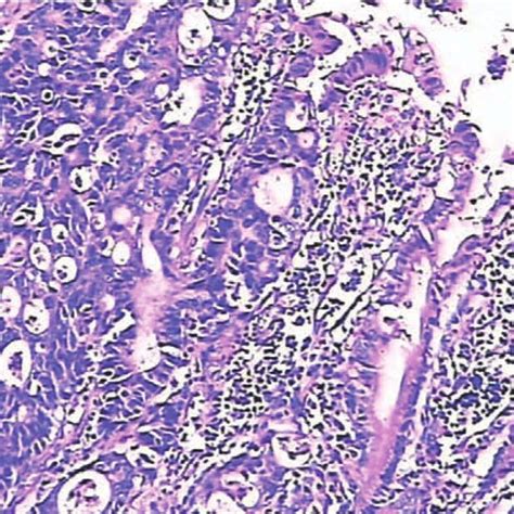 Figure4a Moderately Differentiated Adenocarcinoma Oncocyte Was Noted