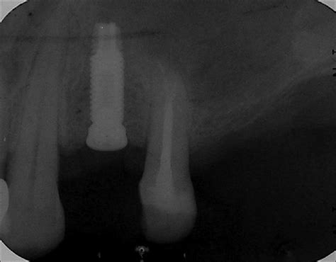 Reconstruction Of Alveolar Bone Defect With Autogenous Bone Particles