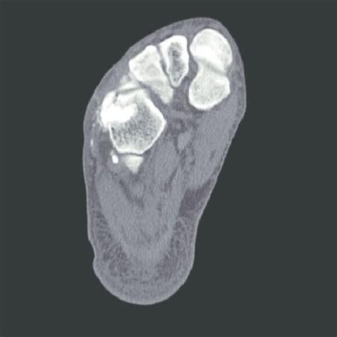 Pdf A Case Report Of Isolated Cuboid Nutcracker Fracture