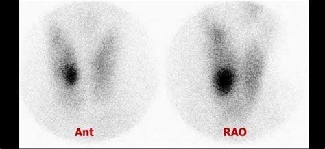 Nuclear Medicine Thyroid Uptake Scan Top Things To Know