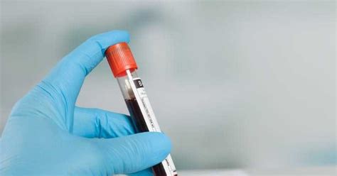 Rapport Cholestérol Total Hdl Supérieur à 5 Calcul Et Norme