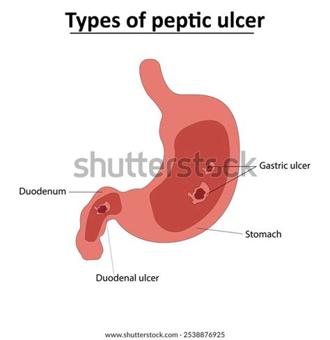 Vector Illustration Types Peptic Ulcer Stock Vector Royalty Free 2538876925 Shutterstock