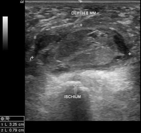 Ischial Bursitis