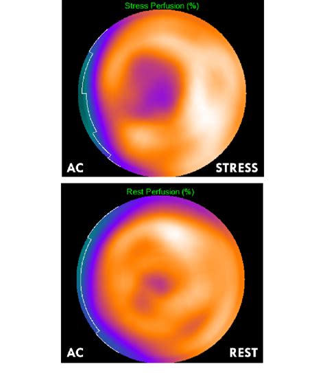 Fused Computed Tomography Attenuation Corrected Myocardial Perfusion Download Scientific