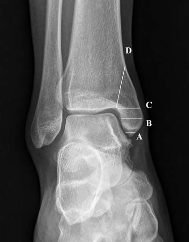 Medial Malleolus Fracture Orthobullets