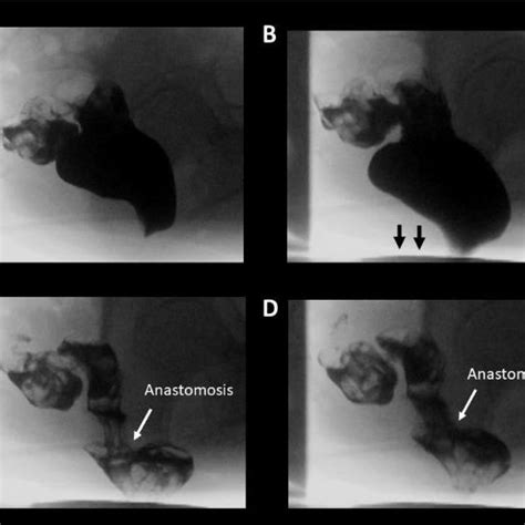 Defecography Of Proctocolectomy Group A Resting B The Descent Of Download Scientific