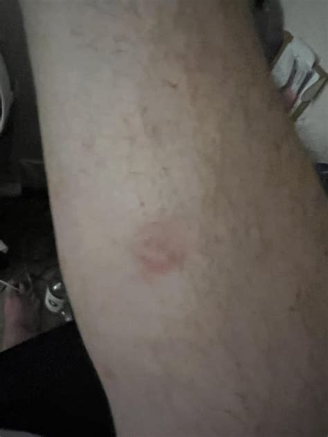 Rash Type R Dermatologyquestions