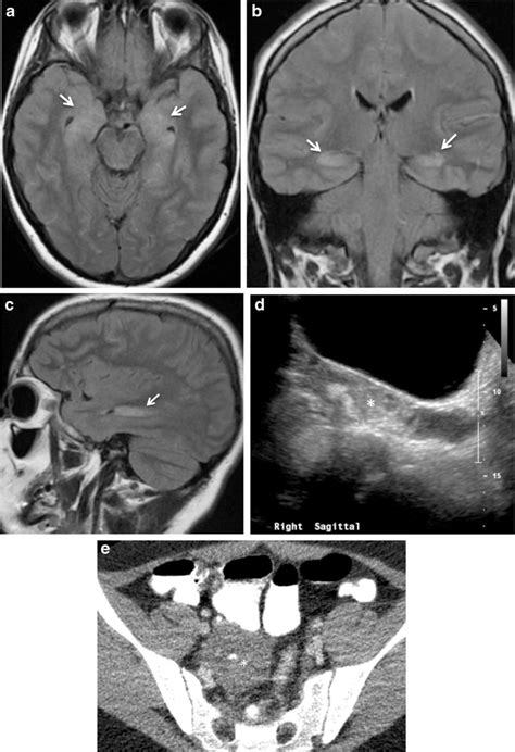 Suspected Limbic Encephalitis In A 16 Year Old Girl Who Presented With