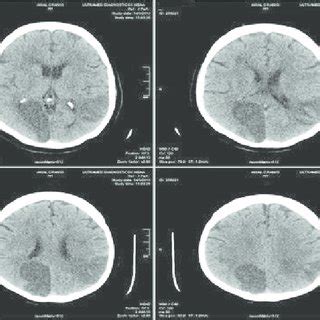A Brain Ct Scan Showing Hypodense Lesions In Subcortical White Matter