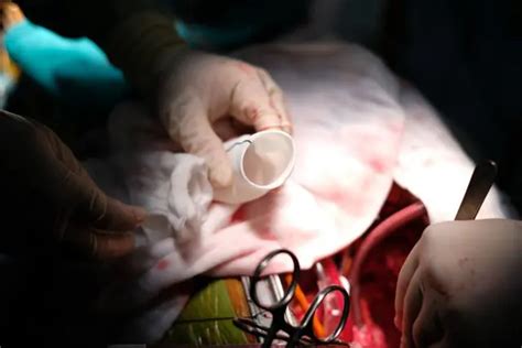 Aortic Dissection Repair Surgery