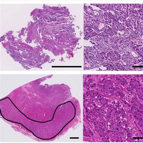 Photomicrographs Of A Case Harboring A Pik3ca Mutation In Both Types Of Download Scientific
