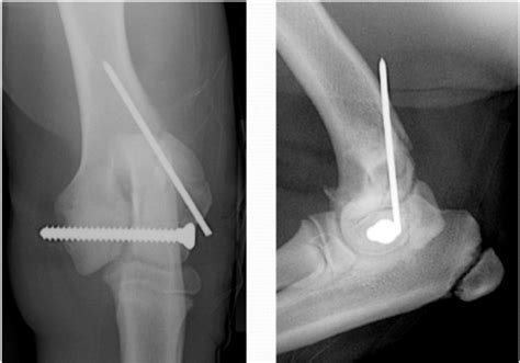 Sams E1 Special Fracture Fixation Flashcards Quizlet