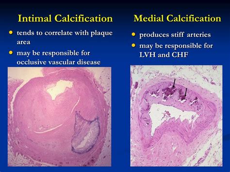 Ppt Peritoneal Dialysis Powerpoint Presentation Free Download Id