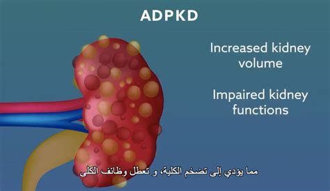 Performance Of The Next Genetic Sequencing Platforms In Diagnosing Adpkd With Arabic Subtitle Ddi