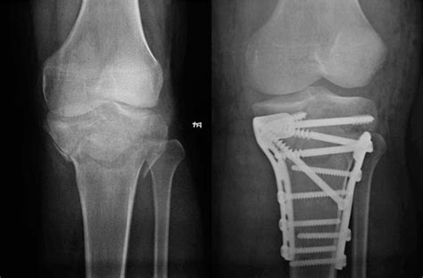 Tibial Plateau Fracture Orif