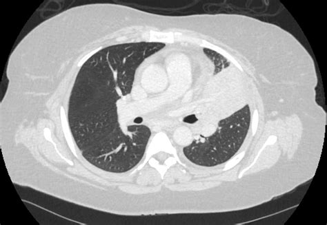 Lingula Lungs