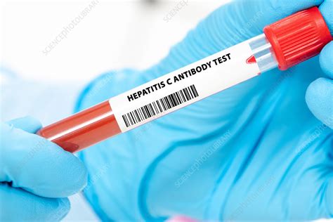 Hepatitis C Antibody Test Stock Image F0447562 Science Photo Library