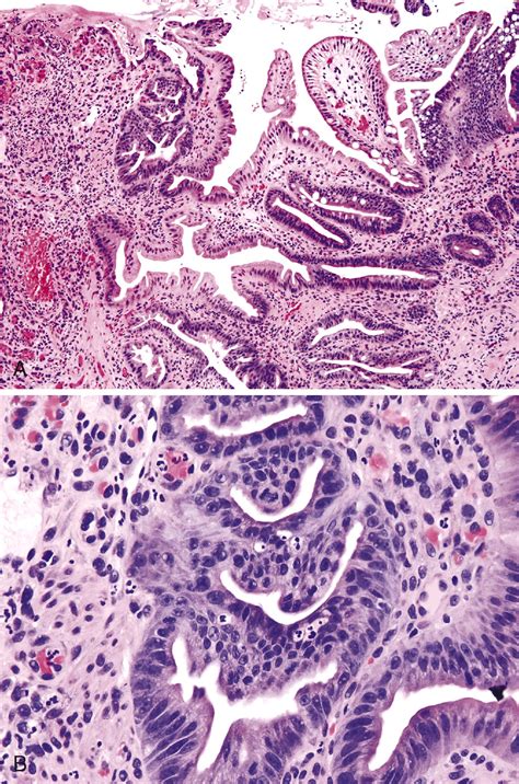 Epithelial Neoplasms Of The Small Intestine Clinical Tree