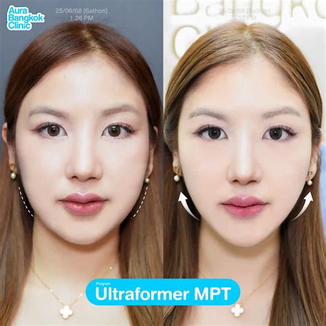 Ultraformer Mpt Before And After Skin Tightening Results