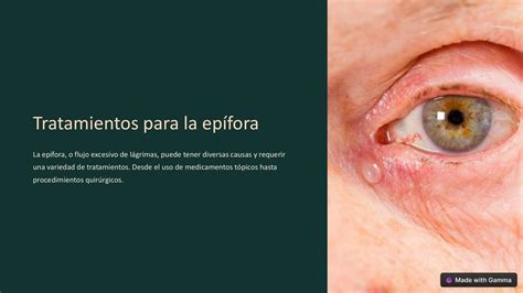 Tratamientos Para La Epifora Eduardo Udocz