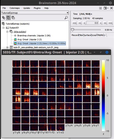 Seeg Epileptogenicity Tutorial Discussions Brainstorm