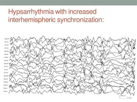 We St Syndrome Eeg