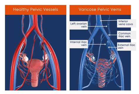 Treatment Pelvic Varicose Veins