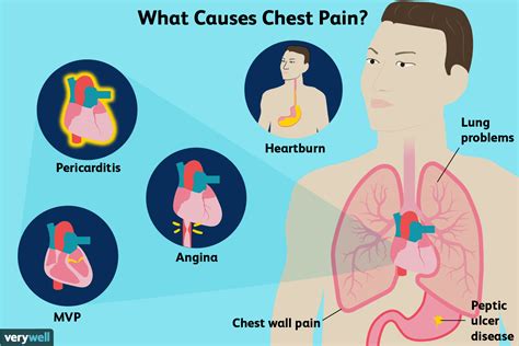 Chest Pain Anatomy