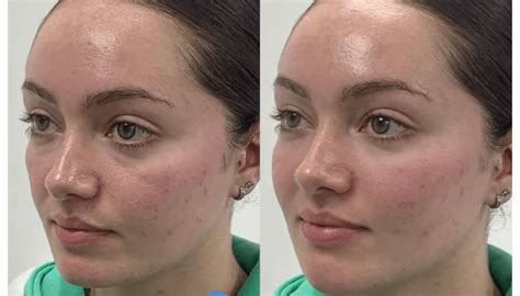 Dermal Fillers Aftercare A Complete Guide Ams Aesthetics