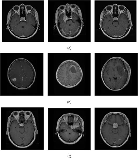 Figure 4 From A Novel Deep Learning Based Brain Tumor Detection Using