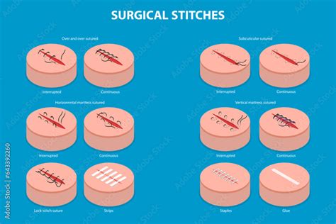 3d Isometric Flat Vector Conceptual Illustration Of Surgical Stitches