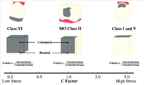Week 4 Class Ii Resin Composite Restoration Flashcards Quizlet