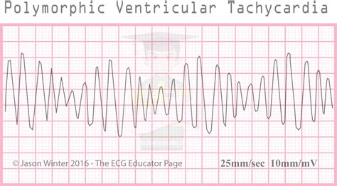 Ecg Educator Blog Ventricular Rhythms