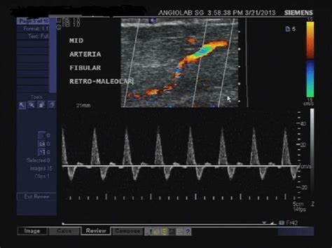 Cross Sectional Us View Of Artery And Peroneal Veins Image Confirms