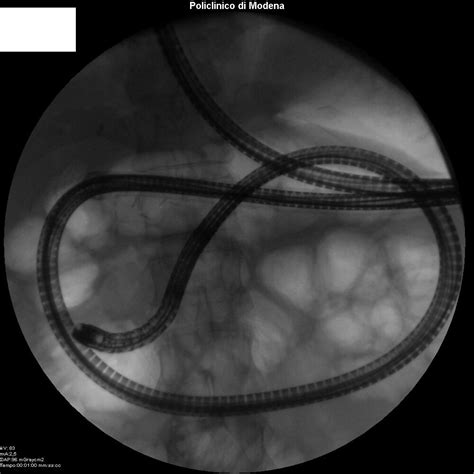Silvia Cocca On Linkedin Aoumodena Ercp Enteroscopy