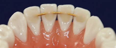 Retainer For Bottom Teeth